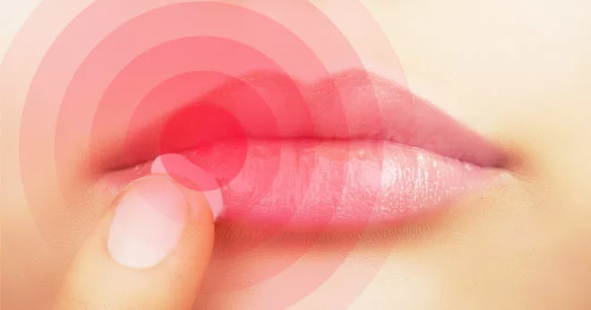 How can I get rid of a cold sore quickly? - Beauty South Africa